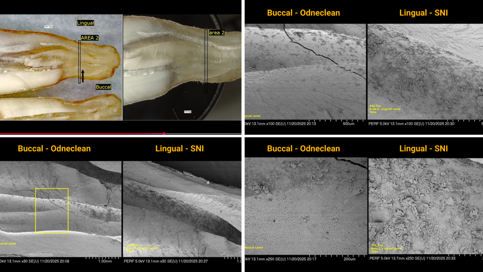 In Vivo Case-Based Investigation: OdneClean Performance in Mandibular ...